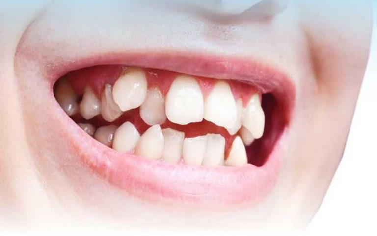 Cara Menghilangkan Gigi Yang Tumbuh Di Gusi | Rintik Sedu